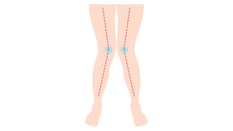 How To Fix Bowed Legs In Adults? (Accurate Answer)